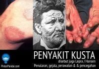 Penyakit Kusta Penularan, Penyebab, Gejala, Perawatan dan Pencegahan