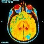 Kanker Otak - Gejala, Pengobatan, Penyebab, Perawatan, Pencegahan