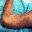 Skleroderma Penyakit Autoimun - Masalah: Kulit, Pembuluh Darah, Otot
