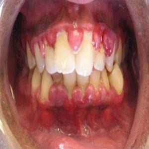 Gusi Bengkak (Gingivitis), Berdarah - Penyakit Periodontal (Penyakit Gusi)