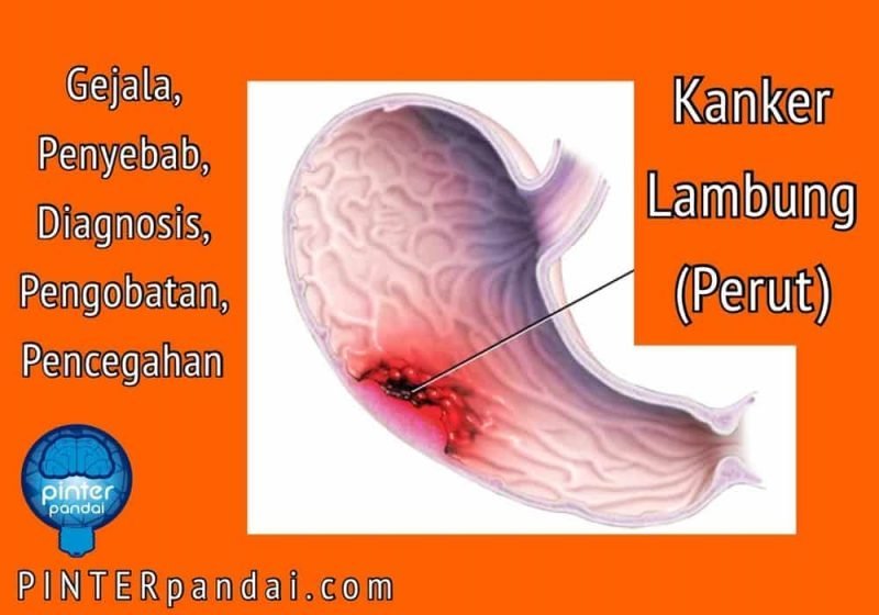 Kanker Lambung (Perut) - Gejala, Penyebab, Diagnosis, Pengobatan