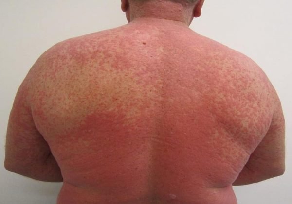 Pengobatan Alergi - Perumperindo.co.id