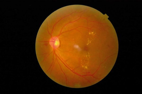 Edema Makula (Gangguan Mata) | Gejala, Penyebab, Perawatan